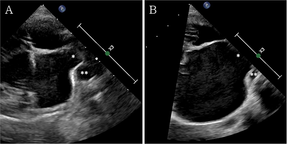 Echocardiographic measures to evaluating progression in MMVD