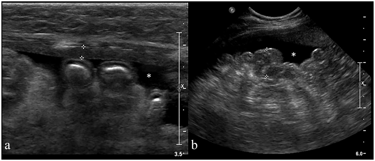 Update on the US appearance of FIP