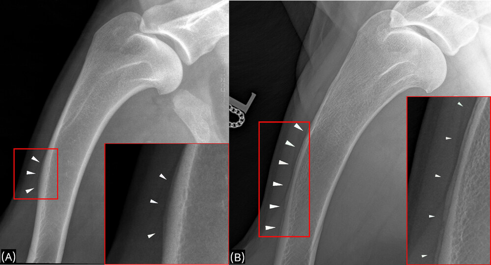 Unveiling the Mystery of Humeral Periosteal Reaction-Like Lesions in Dogs