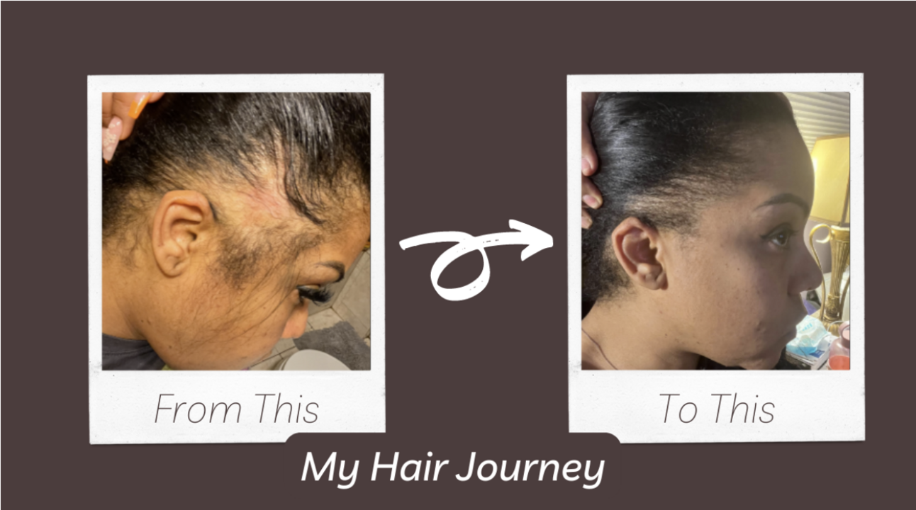 New Insights: How PRP Rebalances the Scalp Microbiome for Hair Regrowth