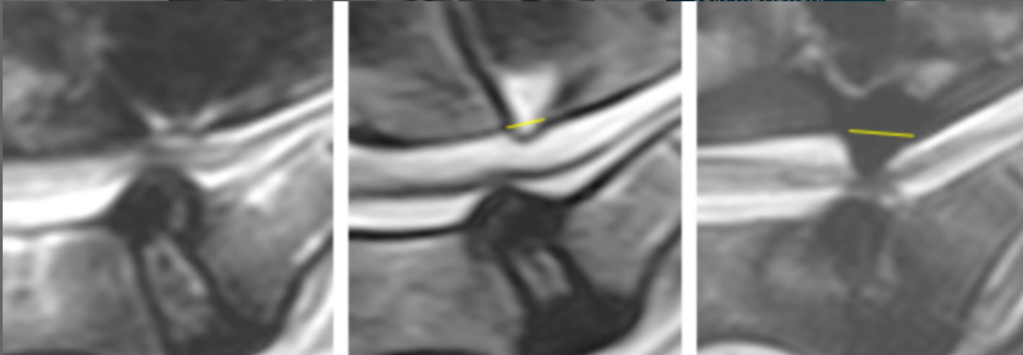 Dynamic MRI Reveals Hidden Lumbosacral Compression in Dogs