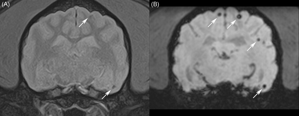 SWI vs T2* which is better for susceptibility?