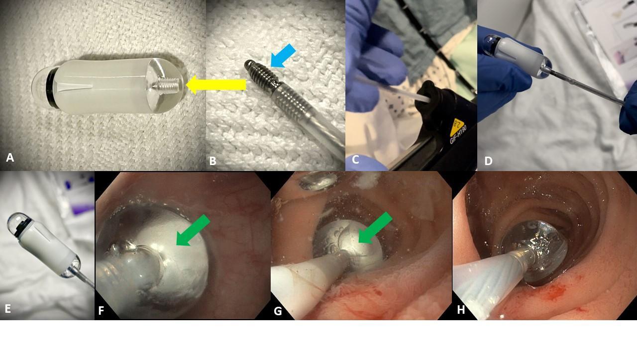 How to Deploy a Capsule Endoscope During EGD