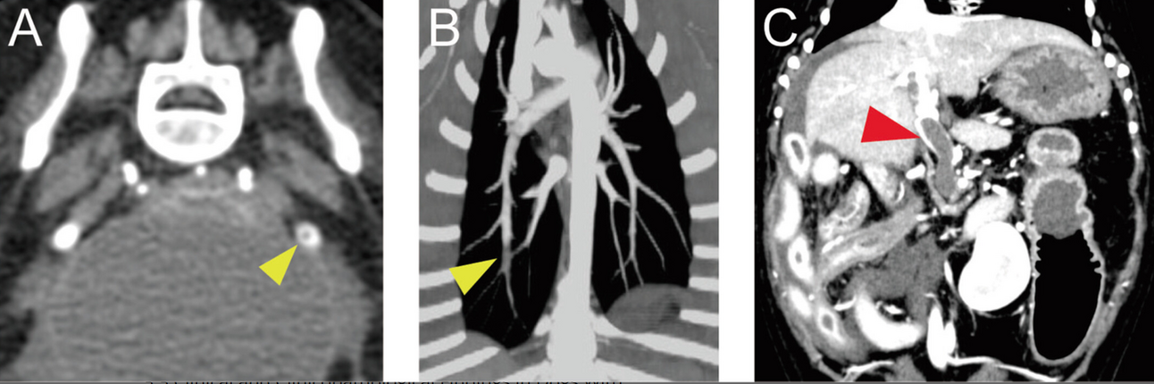 Thrombi Found in 1 in 7 Dogs With PLE—Most Without Clinical Signs