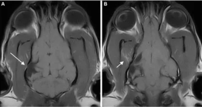 Could early trauma be responsible for porencephaly?