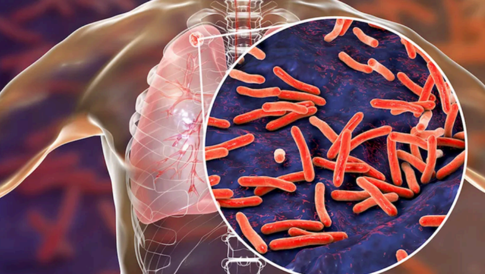 SF Tuberculosis Outbreak Balloons to Over 200 Cases