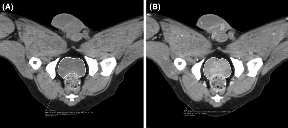 What is the volume of a prostate?