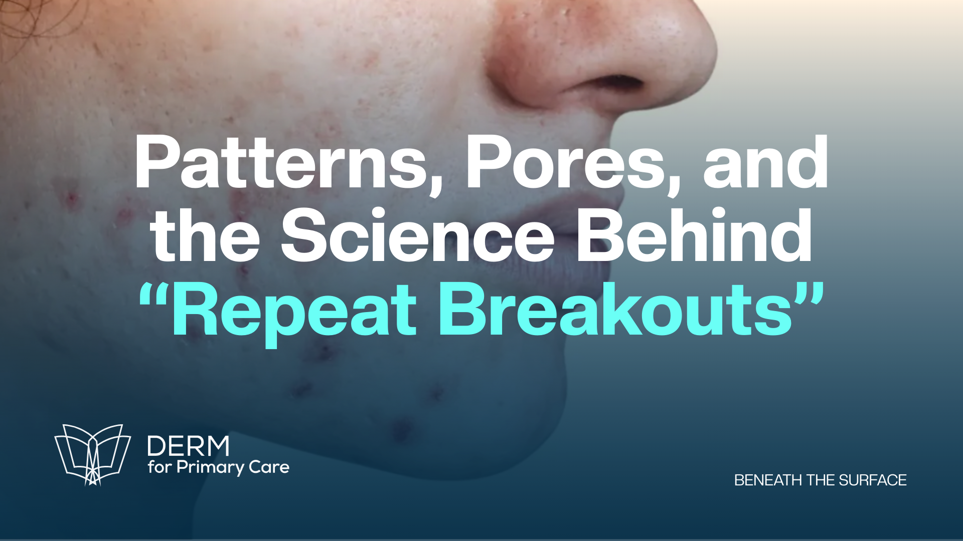 Acne Patterns Decoded: Why Breakouts Repeat & What They Reveal 🧬