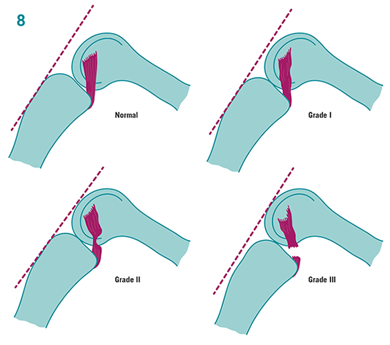 4 Phase PCL Injury Guide