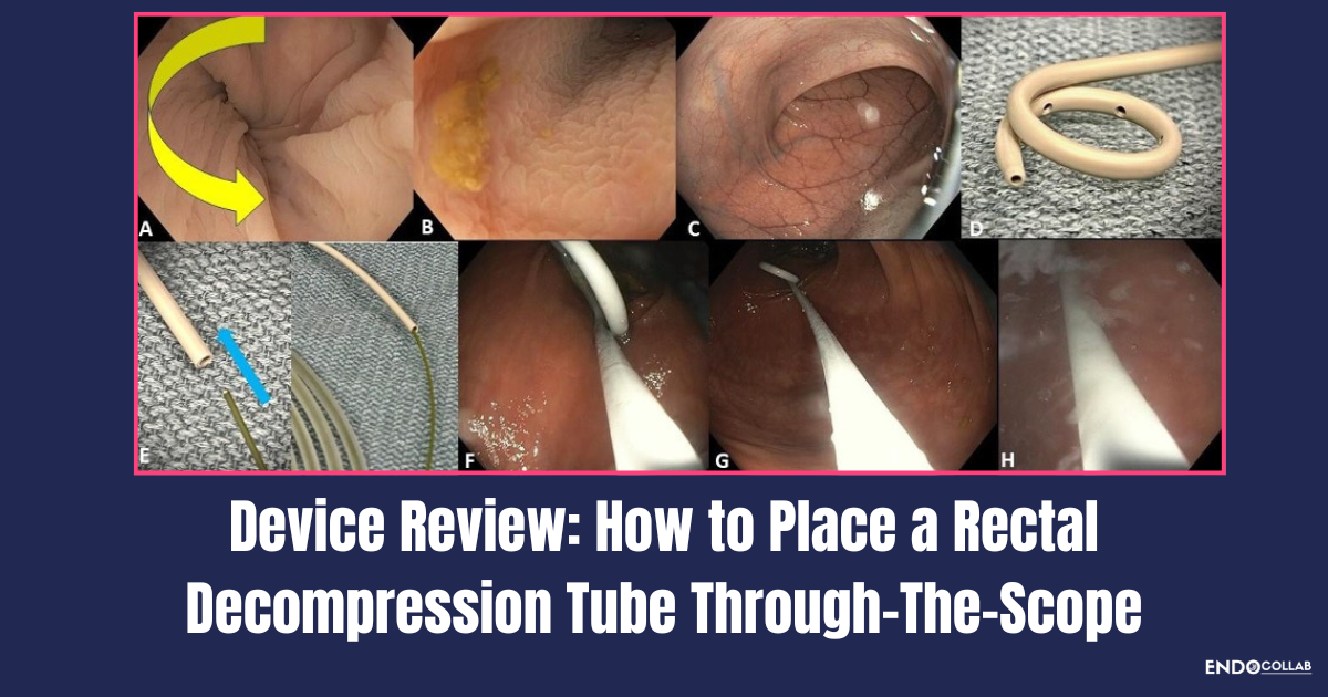 Device Review: How to Place a Rectal Decompression Tube Through-The-Scope