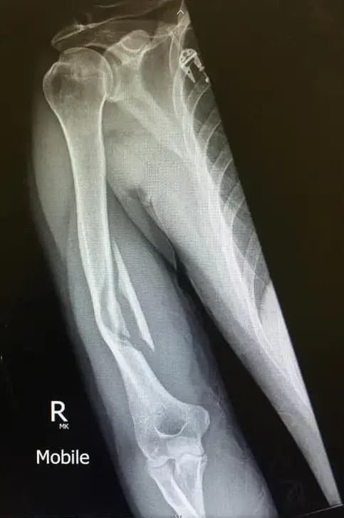 Acceptance: The Hardest First Step