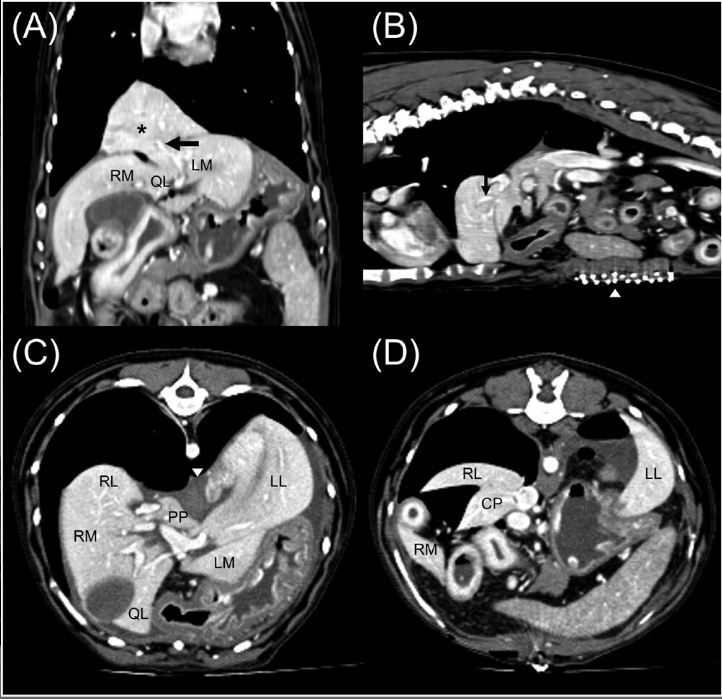 Ever seen an ectopic liver?