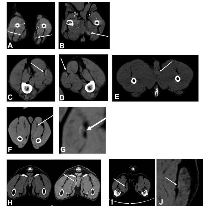 What does gracilis myopathy look like on CT and MRI?