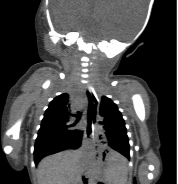 New Publication: Floyd Type III Tracheal Agenesis with Laryngeal Cleft ...