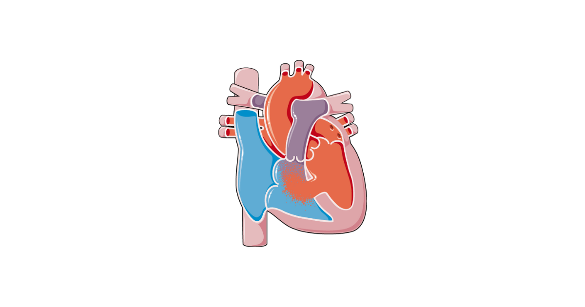#2 - Ventricular Septal Defect (VSD)