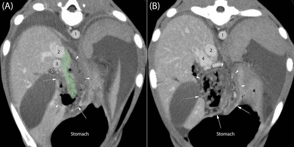 CT appearance of abscesses and cancer of the omentum