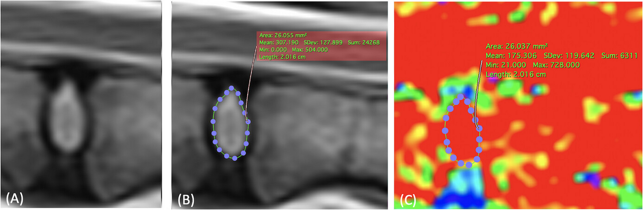 MRI quantitative assessment of canine disc degeneration