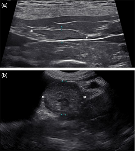 Hypercalcemia may increase the likelihood of lymph node metastases in ...