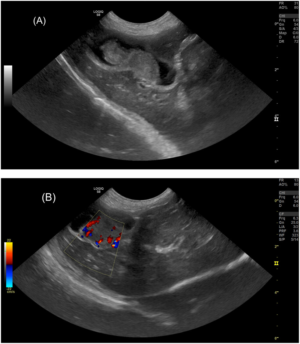 US appearance of GB Neoplasia