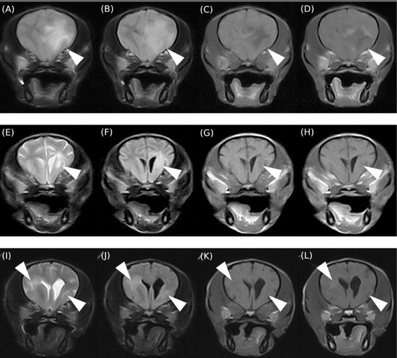 When to Scan Again: MRI Patterns at MUO Relapse Guide Diagnosis and ...