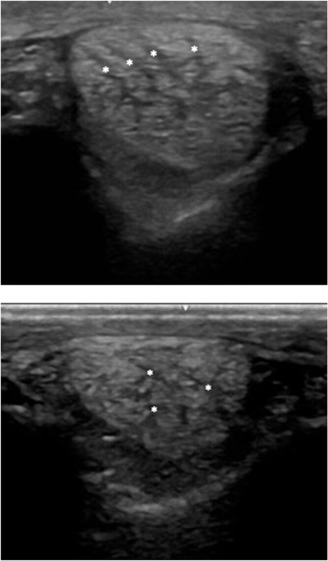 The sonographic appearance of the normal intermediate patellar ligament