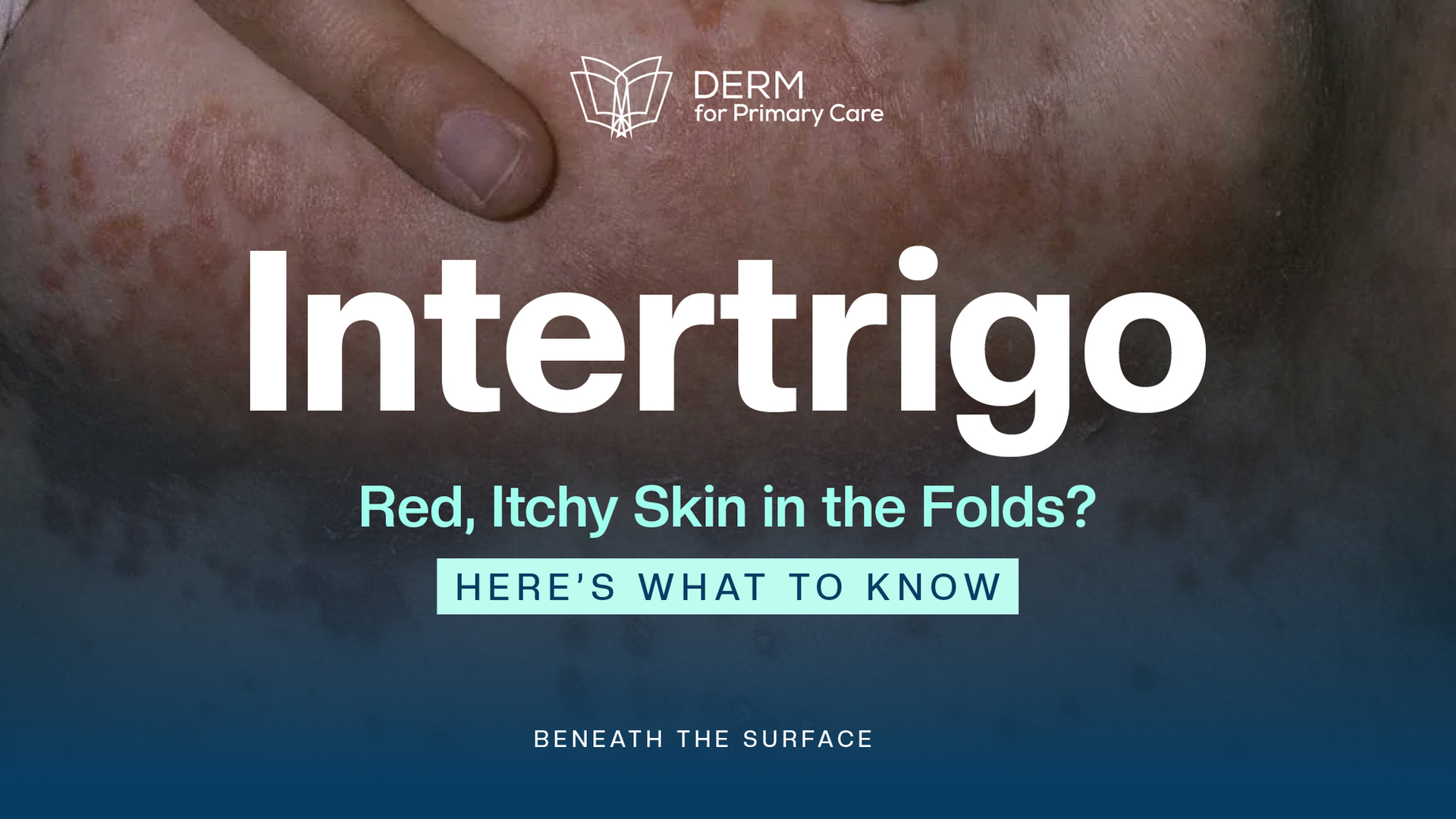 Intertrigo: How to Recognize and Manage This Common Dermatosis