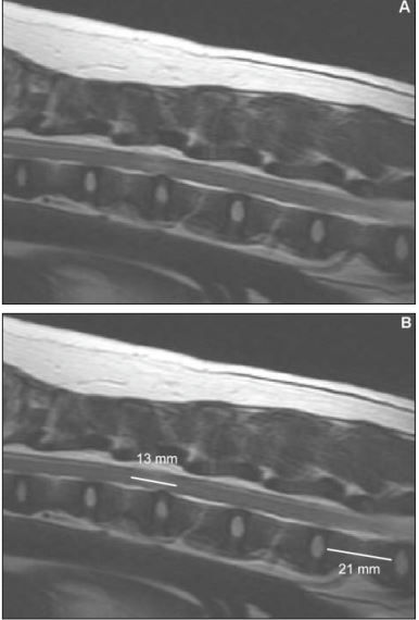 Classic paper: acute noncompressive nucleus pulposus extrusion, MRI and ...