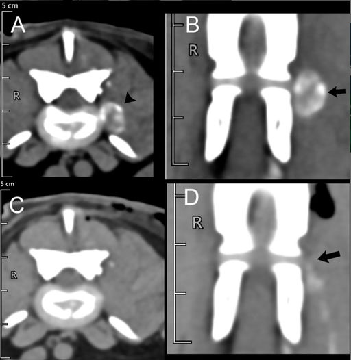 When Prevention Backfires: Nerve Root Compression After Prophylactic ...