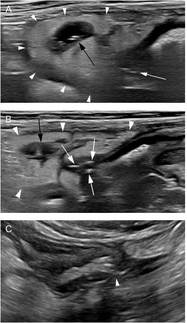 Should we ultrasound GI surgery post op routinely?