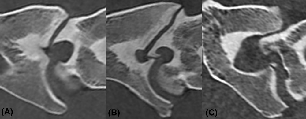 How repeatable is the cervical intraforaminal size on CT?