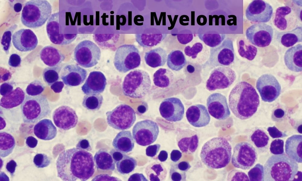 How to Live As A Survivor Of Multiple Myeloma?