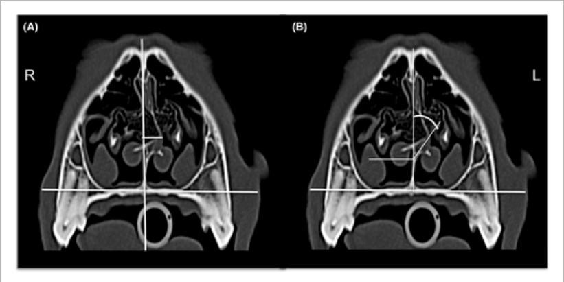 Nasal septum deviation is common and an incidental finding.....