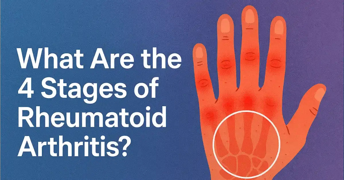 What Are the 4 Stages of Rheumatoid Arthritis?