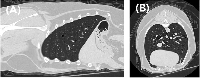 Incidental bullae on CT... what do they mean?!?