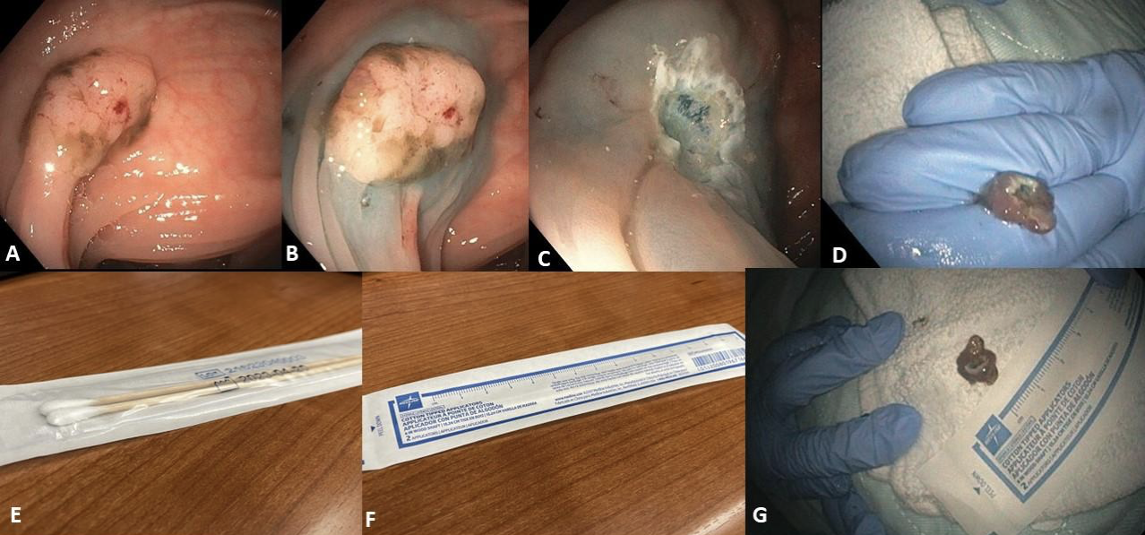 Tips for the Endoscopy Suite: Measurement of Polyp Size using the “QTip ...