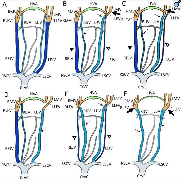 Jugular veins variation-anatomy review