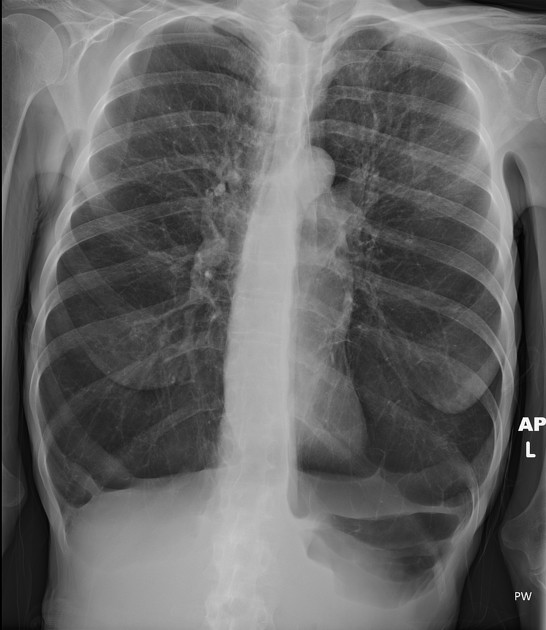 Which finding is most likely in his lower lung lobes?