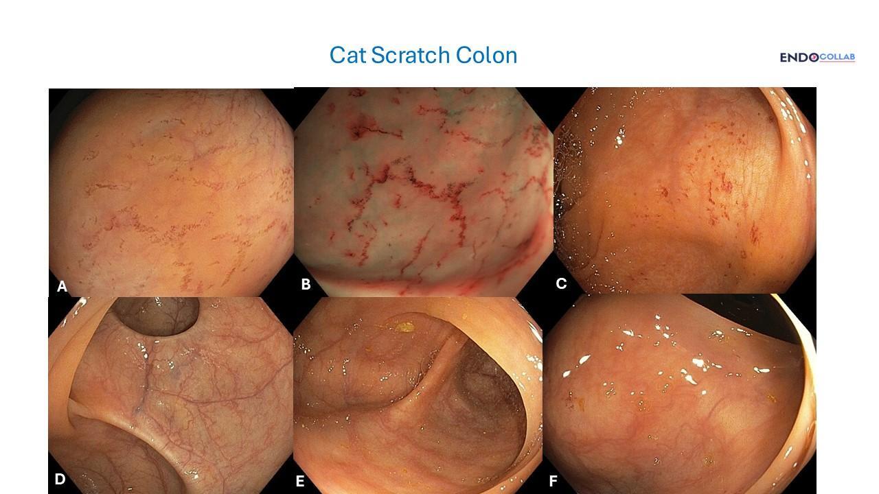 Cat Scratch Colon