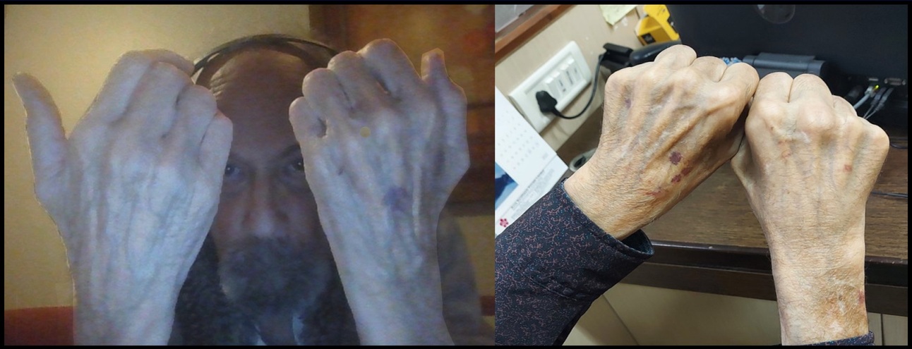 Harold Katcher's rejuvenated hand self-experiment