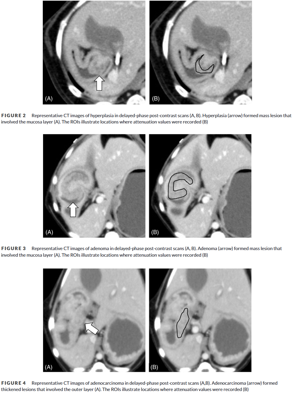 Contrast CT to ID pyloric lesions
