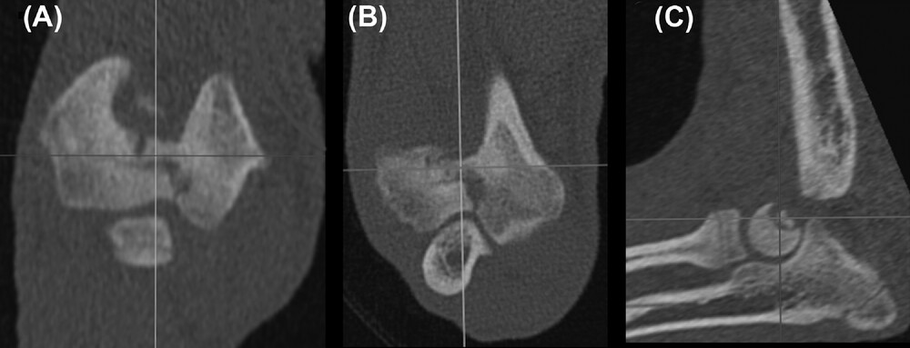 Humeral condylar changes contralateral to a fracture