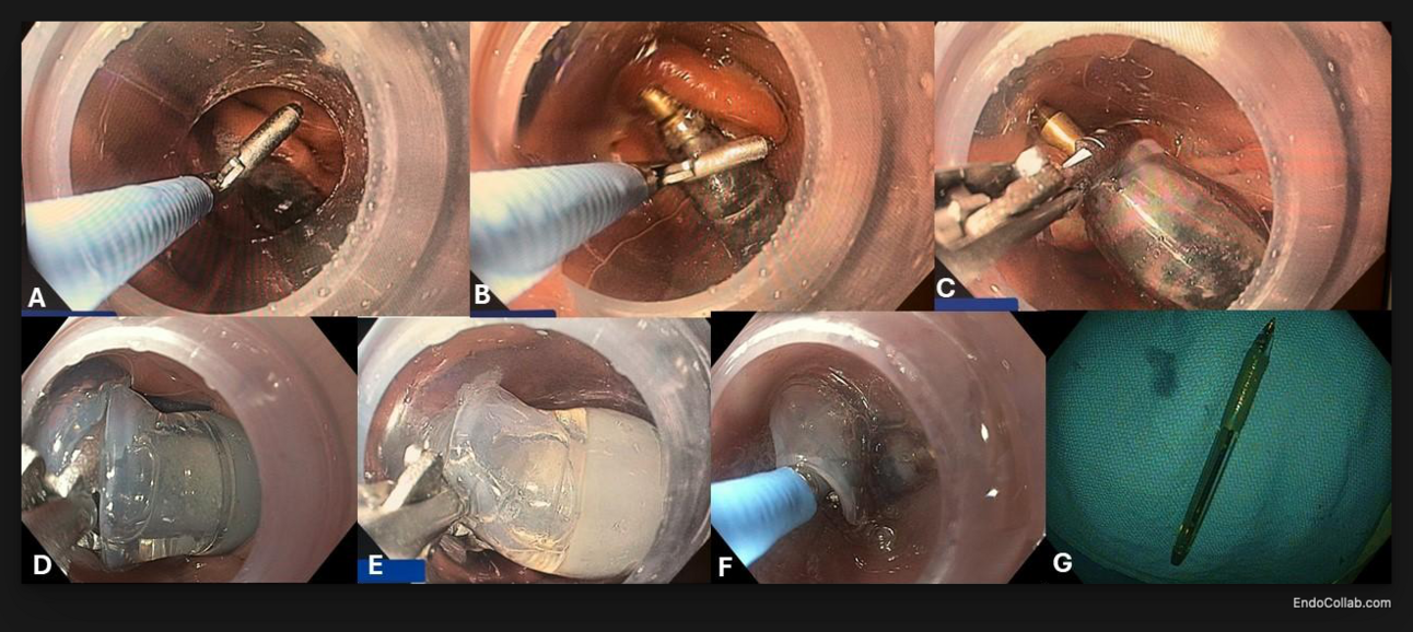 Endoscopic Removal of a Pen Inside the Stomach Using the Soft, Mega ...